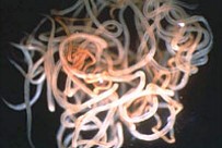 Onchocerciasis (River Blindness)