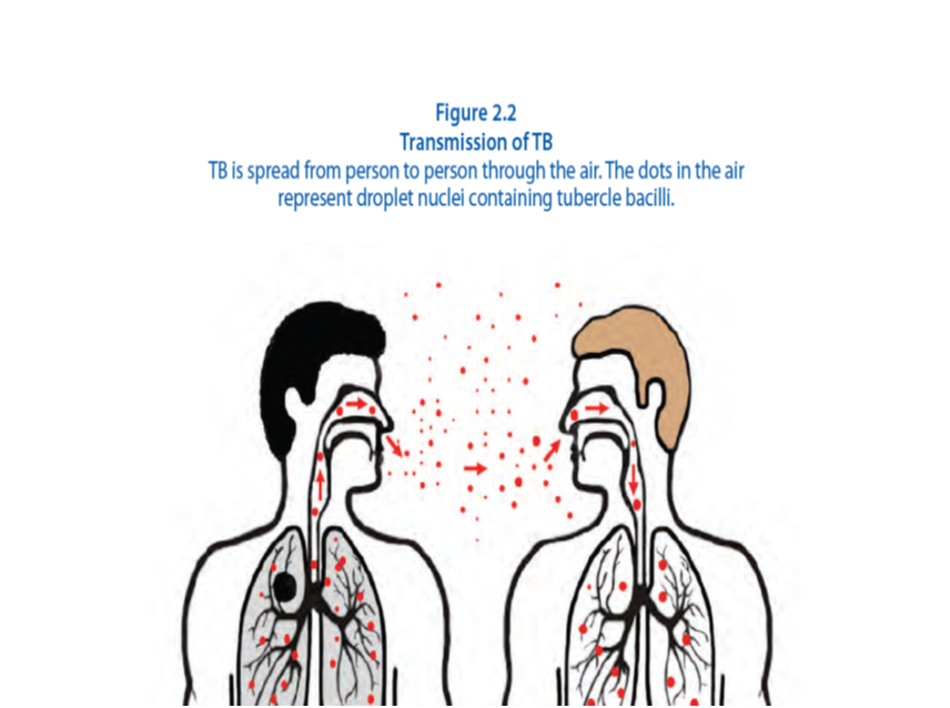 Tuberculosis
