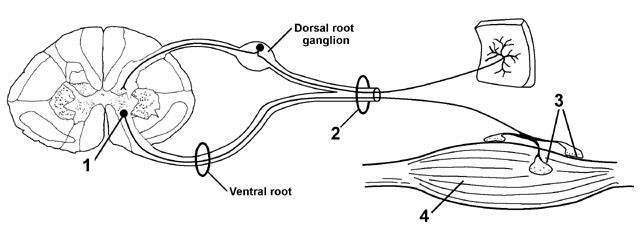 Peripheral and Lower Motor Neuron Lesions