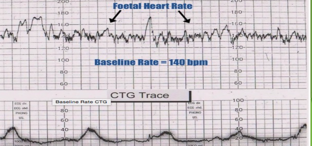Antenatal Fetal Monitoring