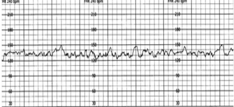Antenatal Fetal Monitoring