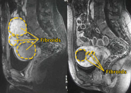 Uterine fibroids