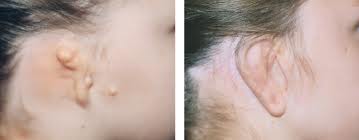 Common Diseases of the Pinna and External Auditory Canal