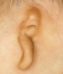 Common Diseases of the Pinna and External Auditory Canal